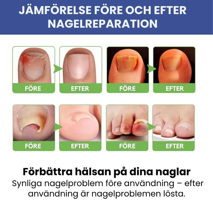 NagelFixer™ | Nagelsvampsbehandling Roll-on – Nordisk Health